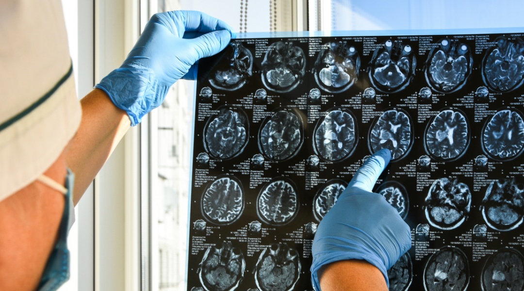 Help for Traumatic Brain Injuries - Roman Empire Agency